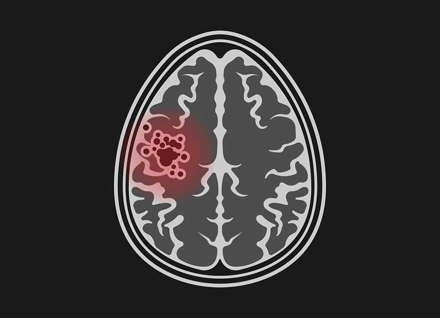 Arteriovenöz Malformasyon (AVM) – Hastalıklar – Dr. Çağrı Canbolat Arteriovenöz Malformasyon (AVM) – Hastalıklar – Dr. Çağrı Canbolat