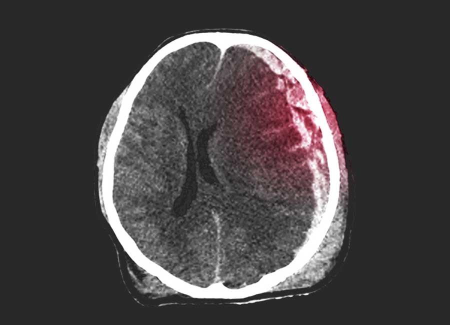 Kronik Subdural Hematom Burr Hole Tedavisi – Tedaviler – Dr. Çağrı Canbolat