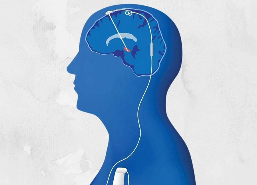 Derin Beyin Stimülasyonu (DBS) – Tedaviler – Dr. Çağrı Canbolat